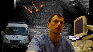 Детское УЗИ мошонки - Состояние после удаления гидатид яичка