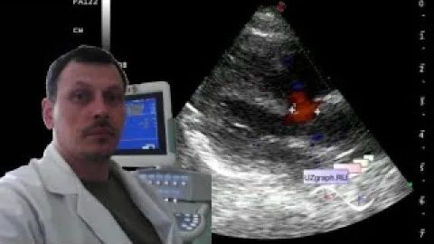 Детское УЗИ сердца (эхокардиография) - Тетрада Фалло до операции