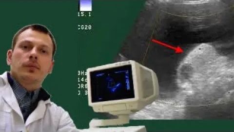 Детское УЗИ органов малого таза - Тератома симулирующая мочевой пузырь