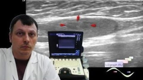 Детское УЗИ мошонки - Поздний крипторхизм плюс