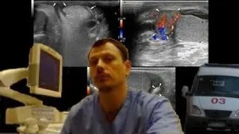 Детское УЗИ мошонки - Травматический эпидидимит