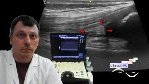 Детское УЗИ коленных суставов - Синовит/бурсит, транзиторная киста мениска