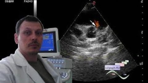 Детское УЗИ сердца (эхокардиография) - Коронарная фистула из левой коронарной артерии