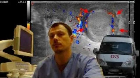 Детское УЗИ мошонки - Неполный перекрут яичка