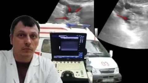 Детское УЗИ органов малого таза - Апоплексия яичника 3