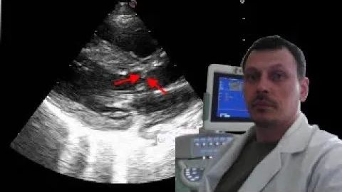 Эхокардиография (УЗИ) - Состояние после коррекции частично открытого атриовентрикулярного канала