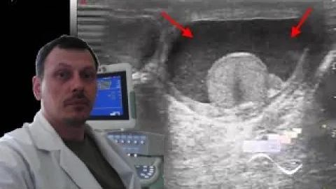 Детское УЗИ мошонки - Водянка мошонки/ гидроцеле