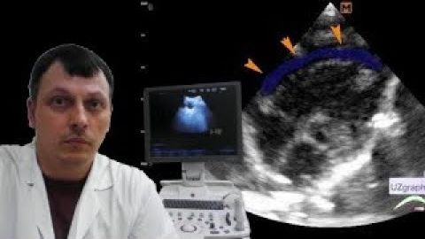 Детская Эхокардиография - Выпот в полости перикарда