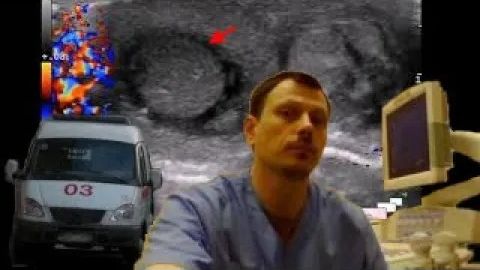 Детское УЗИ мошонки - Неонатальный перекрут яичка на УЗИ