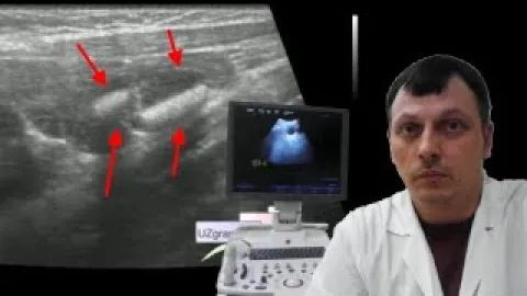 Детское УЗИ вилочковой железы - Диффузно-очаговые изменения тимуса