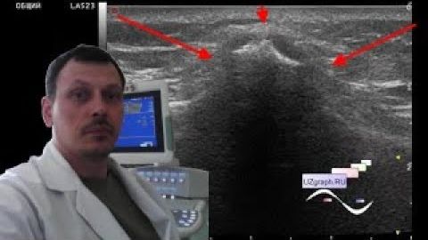 УЗИ коленных суставов - Последствия экстремальных видов спорта