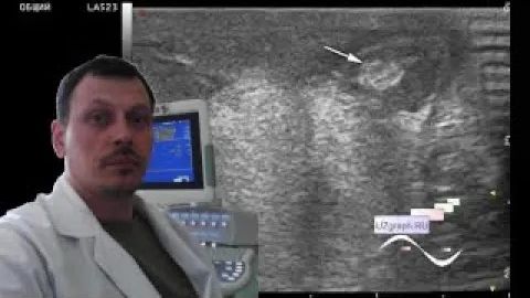 Детское УЗИ мошонки - Монорхизм, рудимент яичка