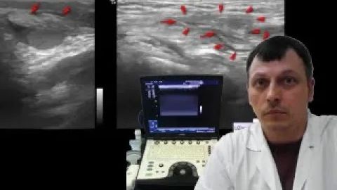 Детское УЗИ мошонки - Состояние после операции(паховая грыжа и/или деферентит)