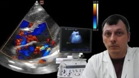 Детское УЗИ сердца (эхокардиография) - Двухструйная регургитация на митральном клапане