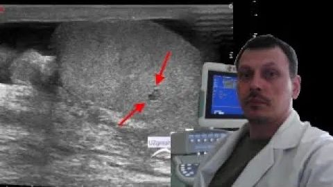 Детское УЗИ мошонки - Тубулярная эктазия сети яичка