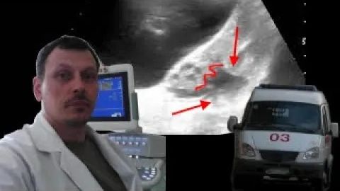 Детское УЗИ органов малого таза - Апоплексия яичника