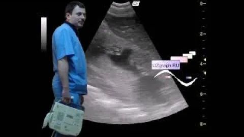 Детское УЗИ почек - Симптом белых почек