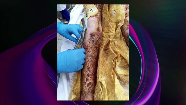 Ожоговый травматизм - страшно, больно и долго 16+