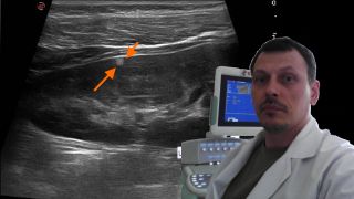 Детское УЗИ почек - Мелкая ангиомиолипома почки