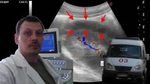 Детское УЗИ почек - Разрыв почки