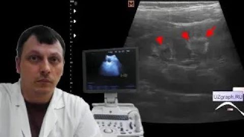 Детское УЗИ почек - Симптом перимедуллярного кольца / медуллярный нефрокальциноз