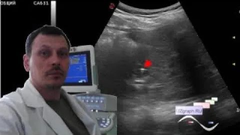 Детское УЗИ почек - Беременность и уролитиаз
