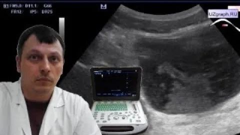 Детское УЗИ мочевого пузыря - Взвесь в мочевом пузыре (соли)