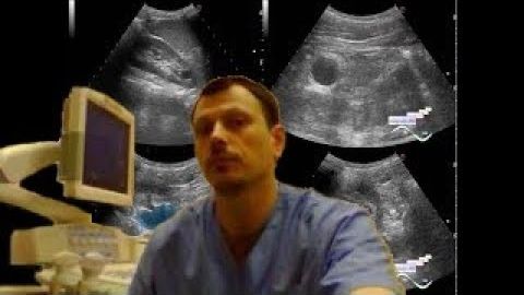 Детское УЗИ почек - Вентильный конкремент лоханки