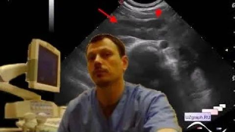 Детское УЗИ почек - Гидронефроз половины подковообразной почки