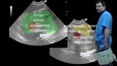 Детское УЗИ почек - Подковообразная почка и мегауретер