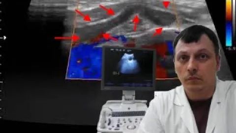 Детское УЗИ костей - Экзостоз vs Синостоз