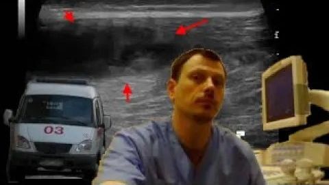 Детское УЗИ костно-мышечной системы - Разрыв мышц голени, гематома