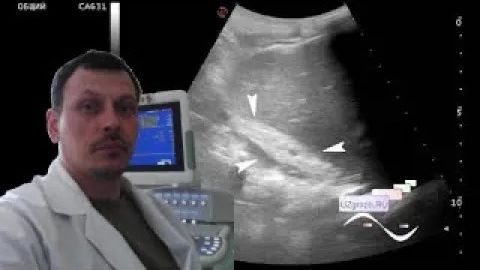 Детское УЗИ почек - Кистозная дисплазия почки