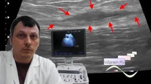 Детское УЗИ мягких тканей - Лимфогематома Морель-Лавалле