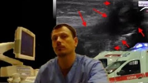 Детское УЗИ мягких тканей -  Незаращение урахуса