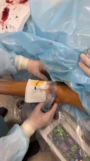 Наш Ньюмен для гемостаза плечевого доступа