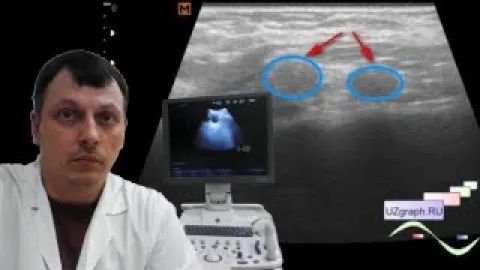 Детское УЗИ костей - Бифуркация ребра (вилка Люшке)