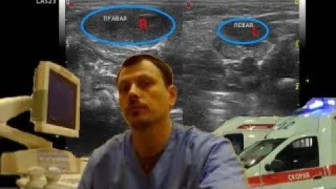 Детское УЗИ костно-мышечной системы - Кривошея у новорожденного