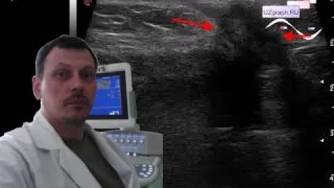 Детское УЗИ мягких тканей - Послеоперационный свищ передней брюшной стенки