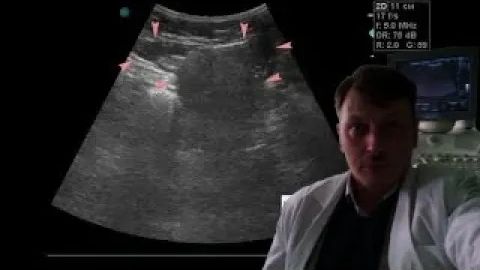 УЗИ мягких тканей - Грыжа белой линии живота/ вентральная