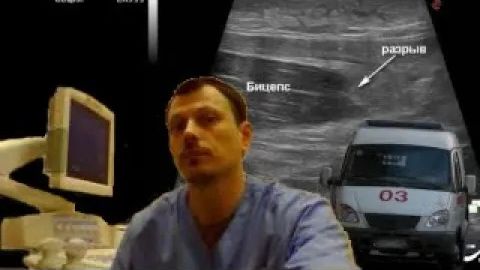 Детское УЗИ костно-мышечной системы - Разрыв бицепса