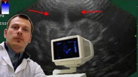 Нейросонография - Хроническая субдуральная гематома/ гигрома