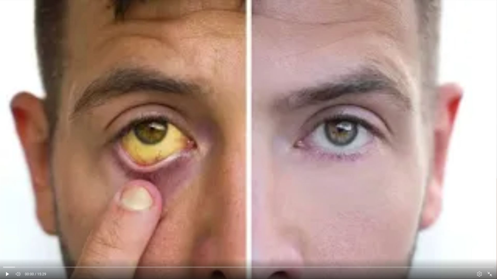 Аппарат Импловит, «Катушка Мишина». Помощь при Гепатитах и заболеваниях печени.