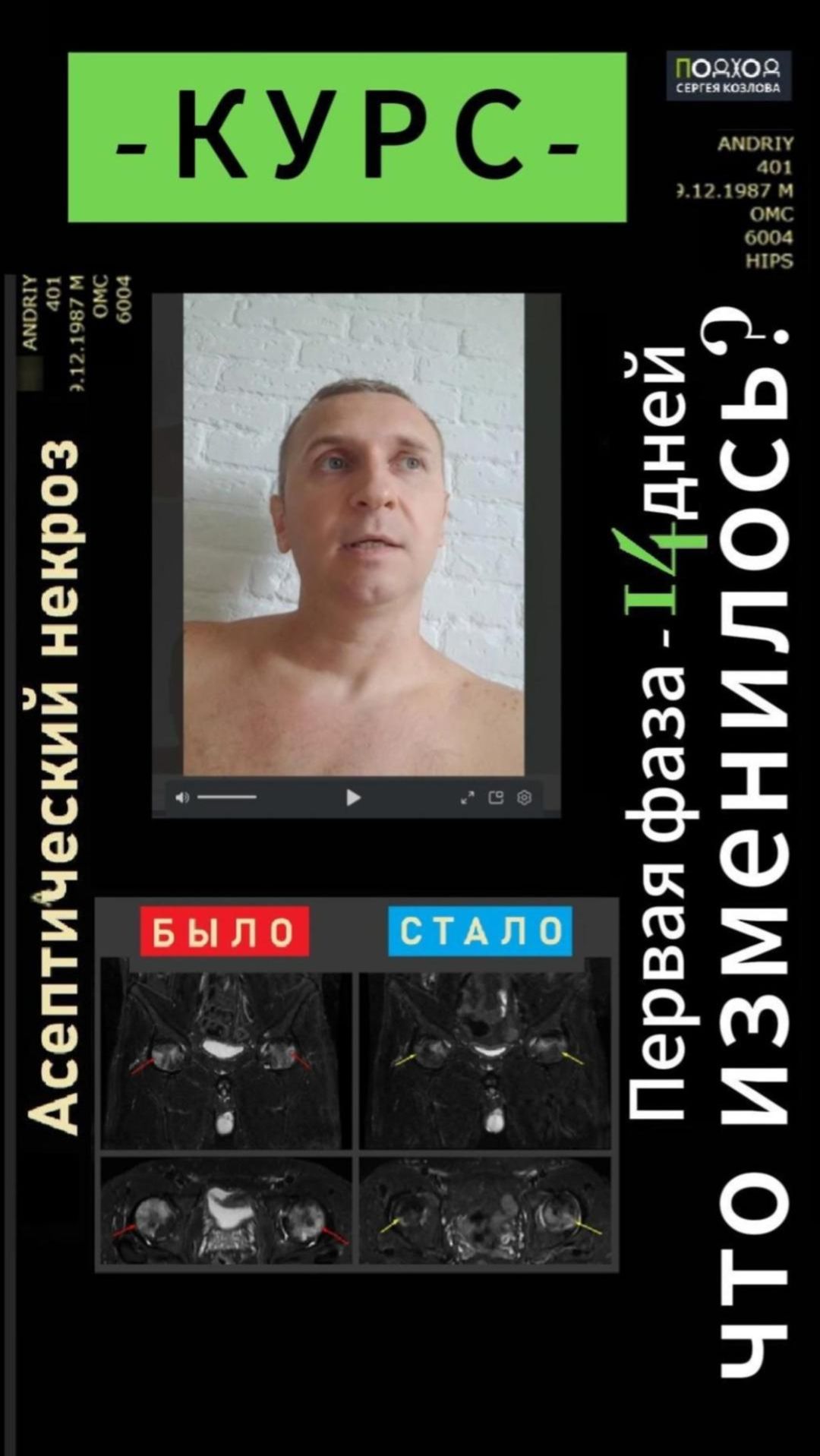 Первая фаза программы восстановления суставов от асептического некроза АНГБК