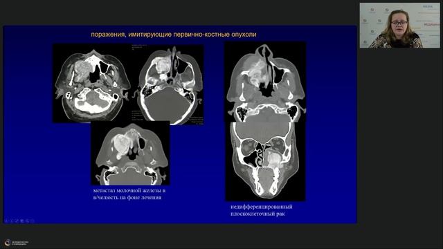 Образования лицевого скелета и околоносовых пазух. Так ли все сложно Или не все так просто