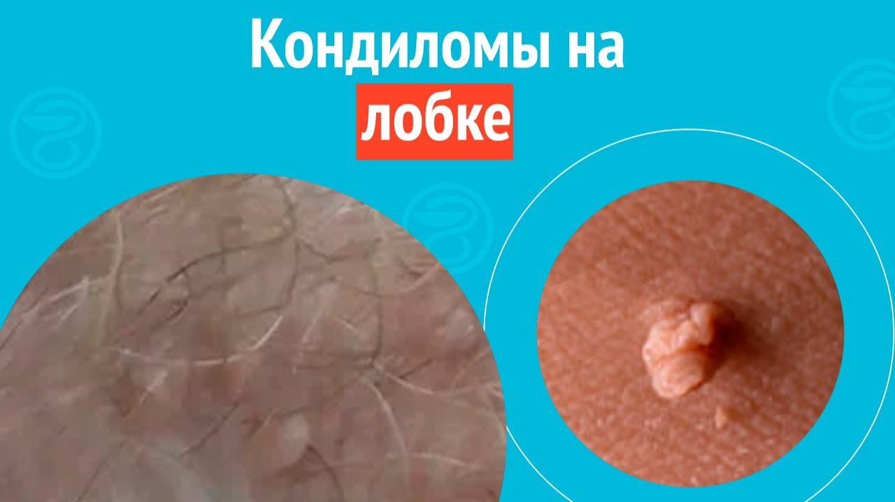 😠 Кондиломы на лобке. Клинический случай №1590
