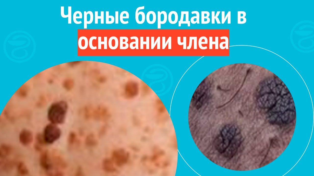 😦 Черные бородавки в основании члена. Клинический случай №1580