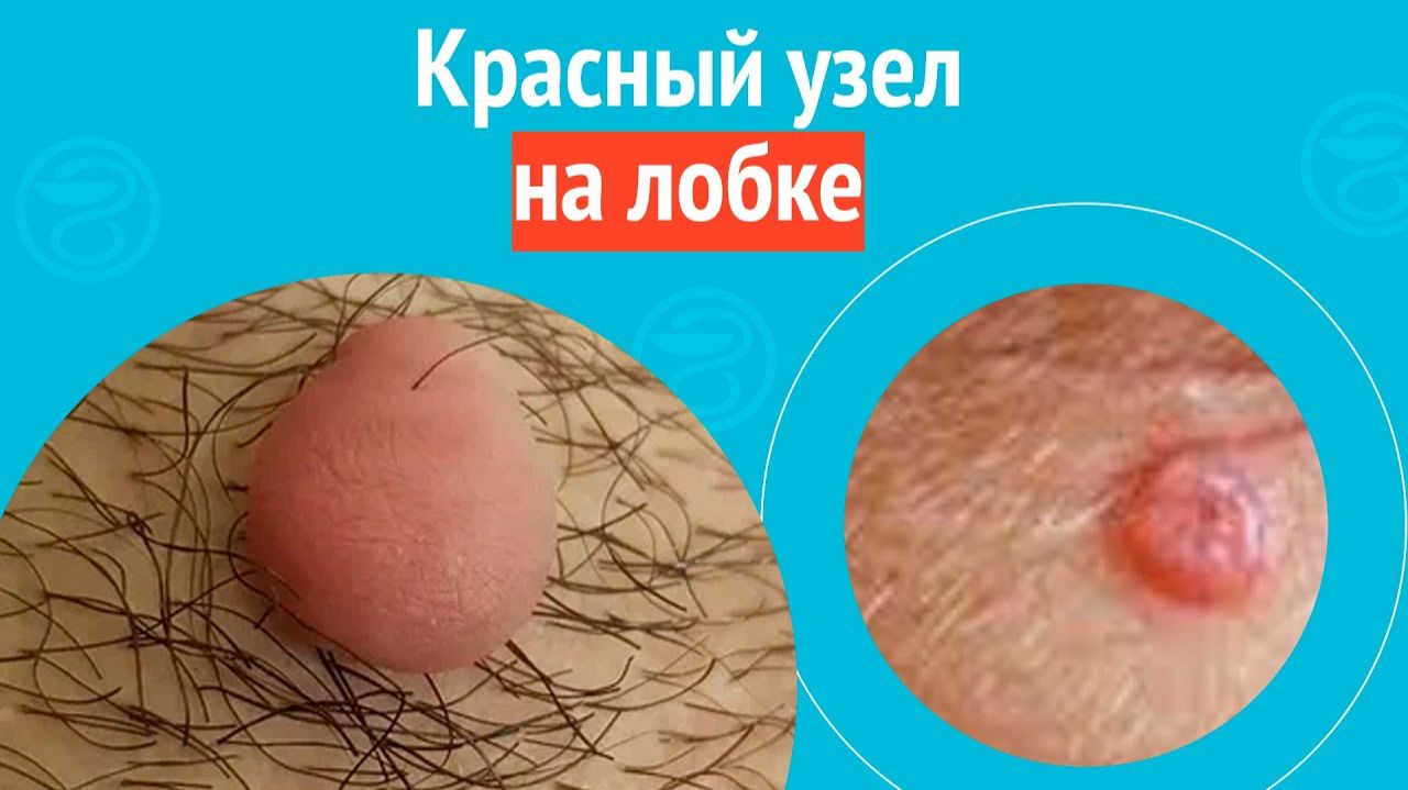 😡 Красный узел на лобке. Клинический случай №1607