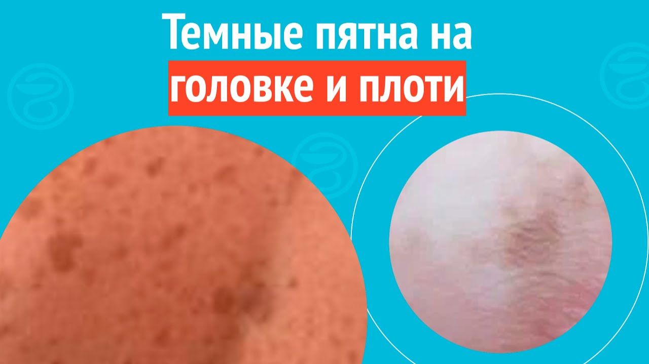 😧 Темные пятна на головке и плоти. Клинический случай №1584
