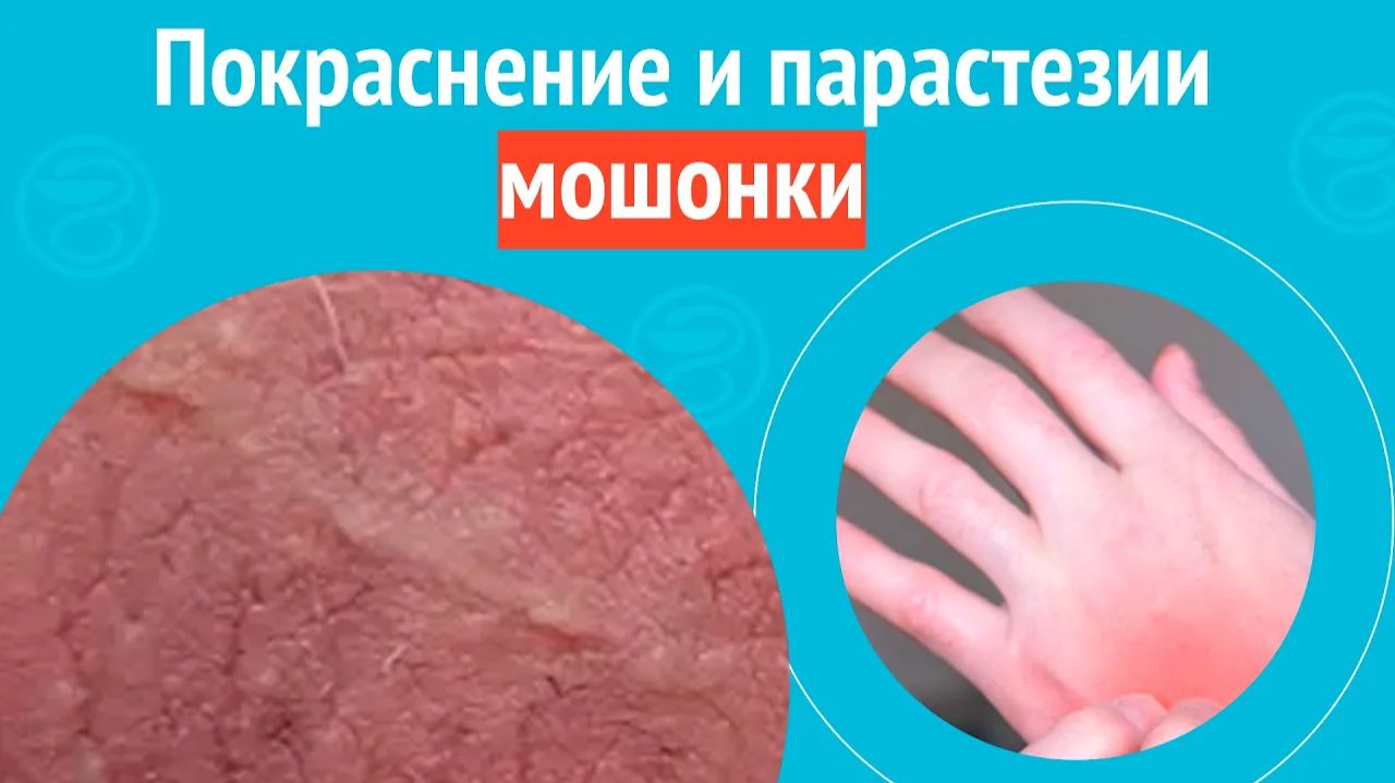 😦 Покраснение и парастезии мошонки. Клинический случай №1595